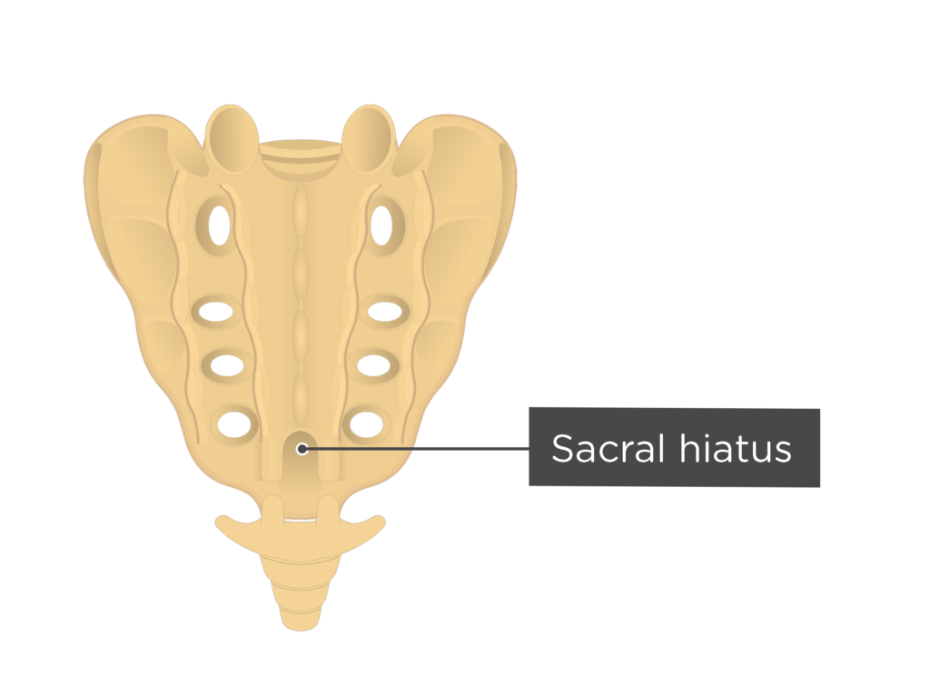 Fused Sacral Hiatus